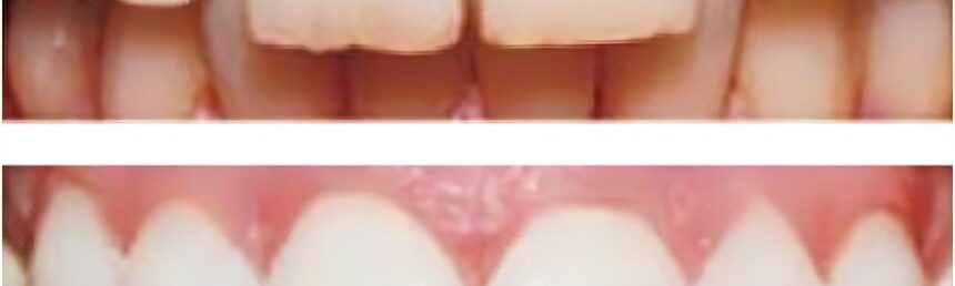 Que savoir sur la couronne zircone avant après avis et prix ? - L'as du ...